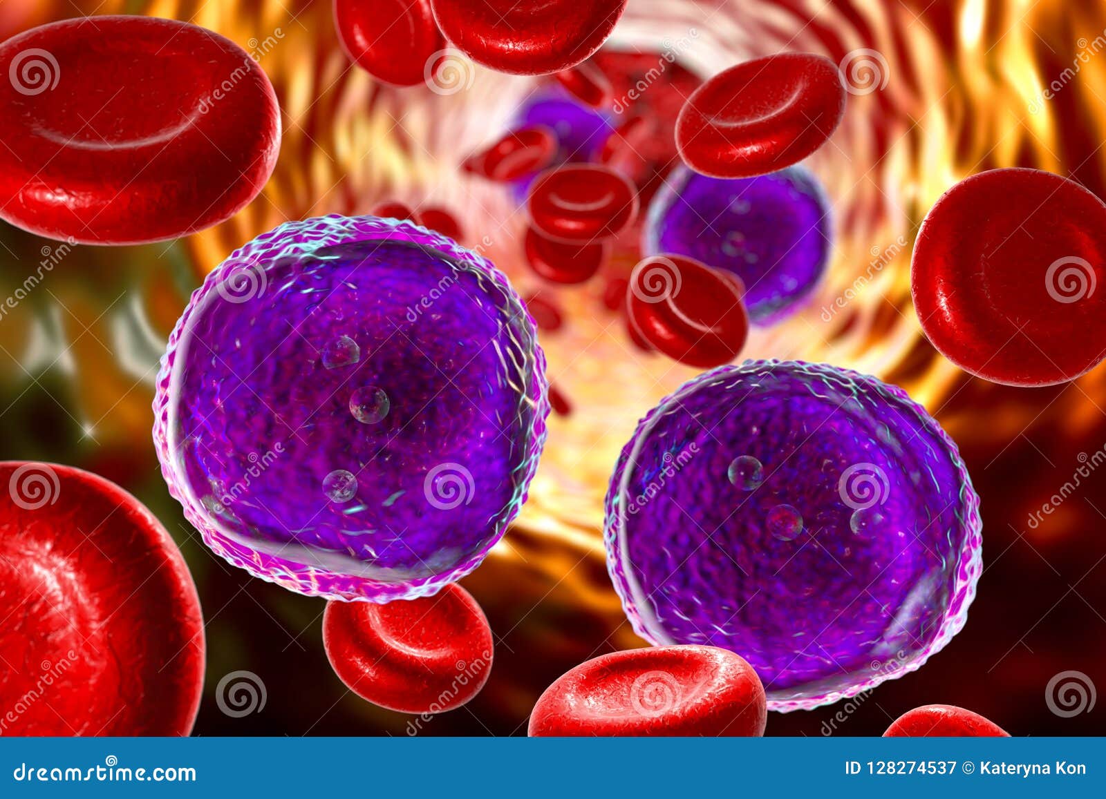 Acute Lymphoblastic Leukemia Stock Illustration - Illustration of ...