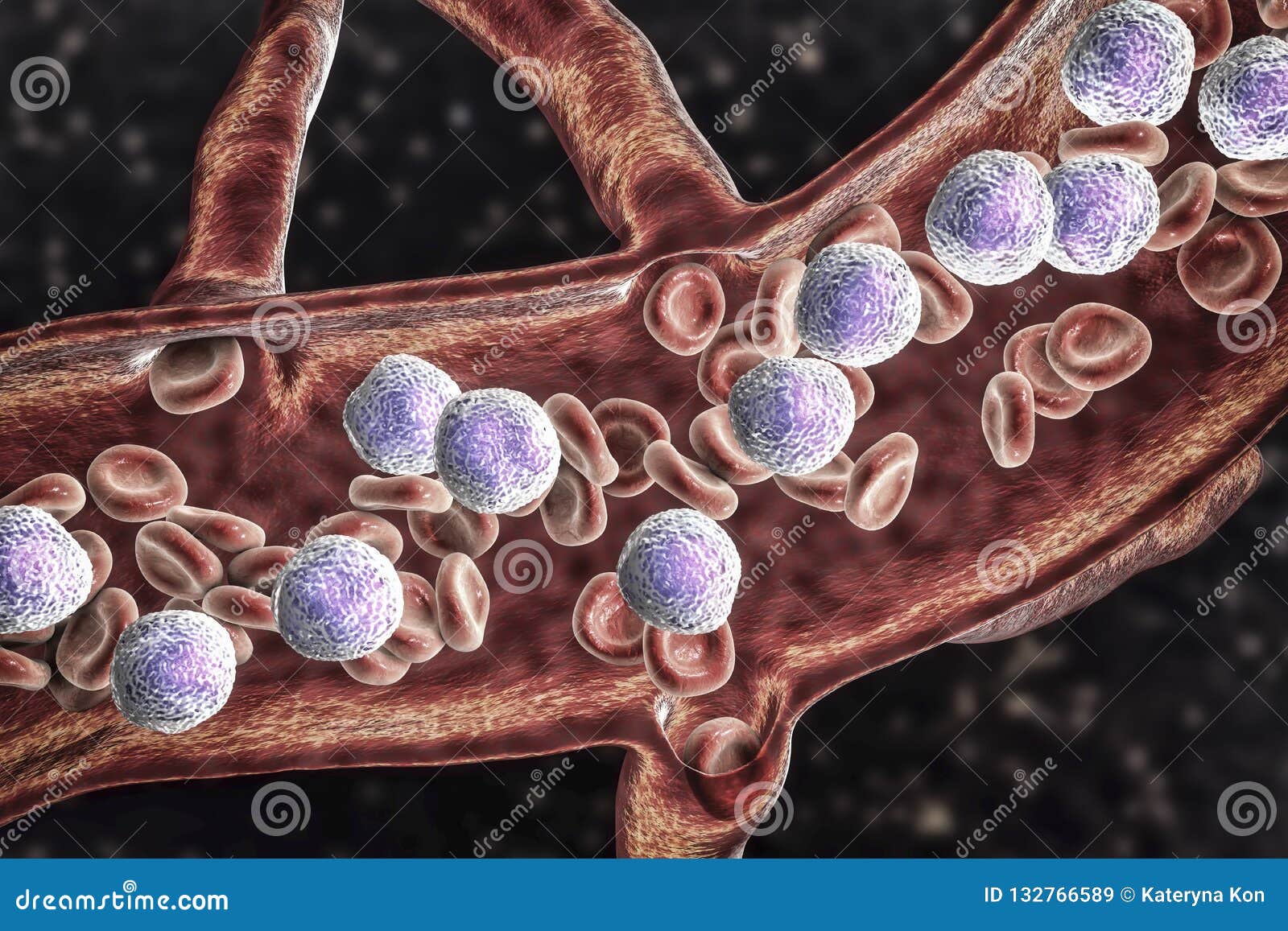 Acute Lymphoblastic Leukemia Stock Illustration - Illustration of ...