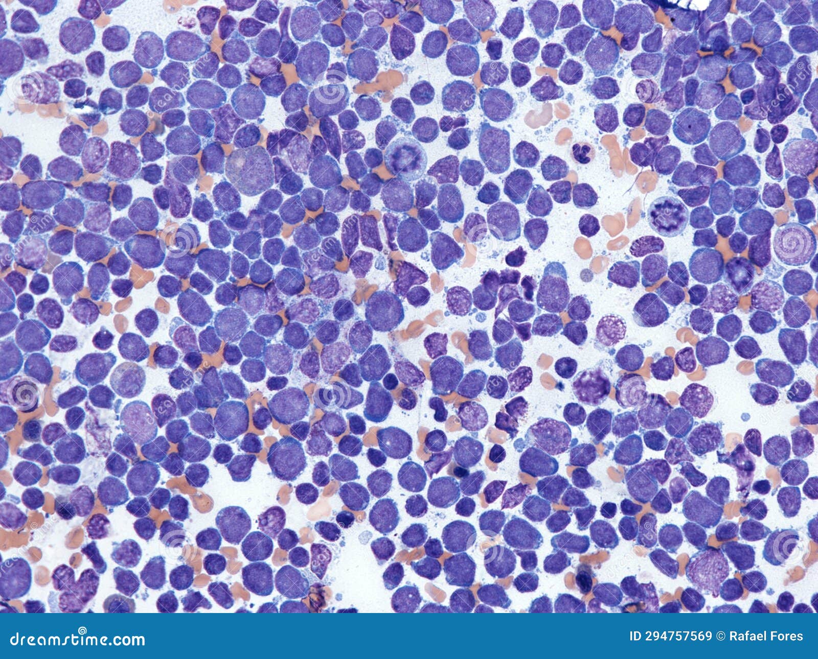 Acute Lymphoid Leukemia in Bone Marrow. Stock Image - Image of medical ...