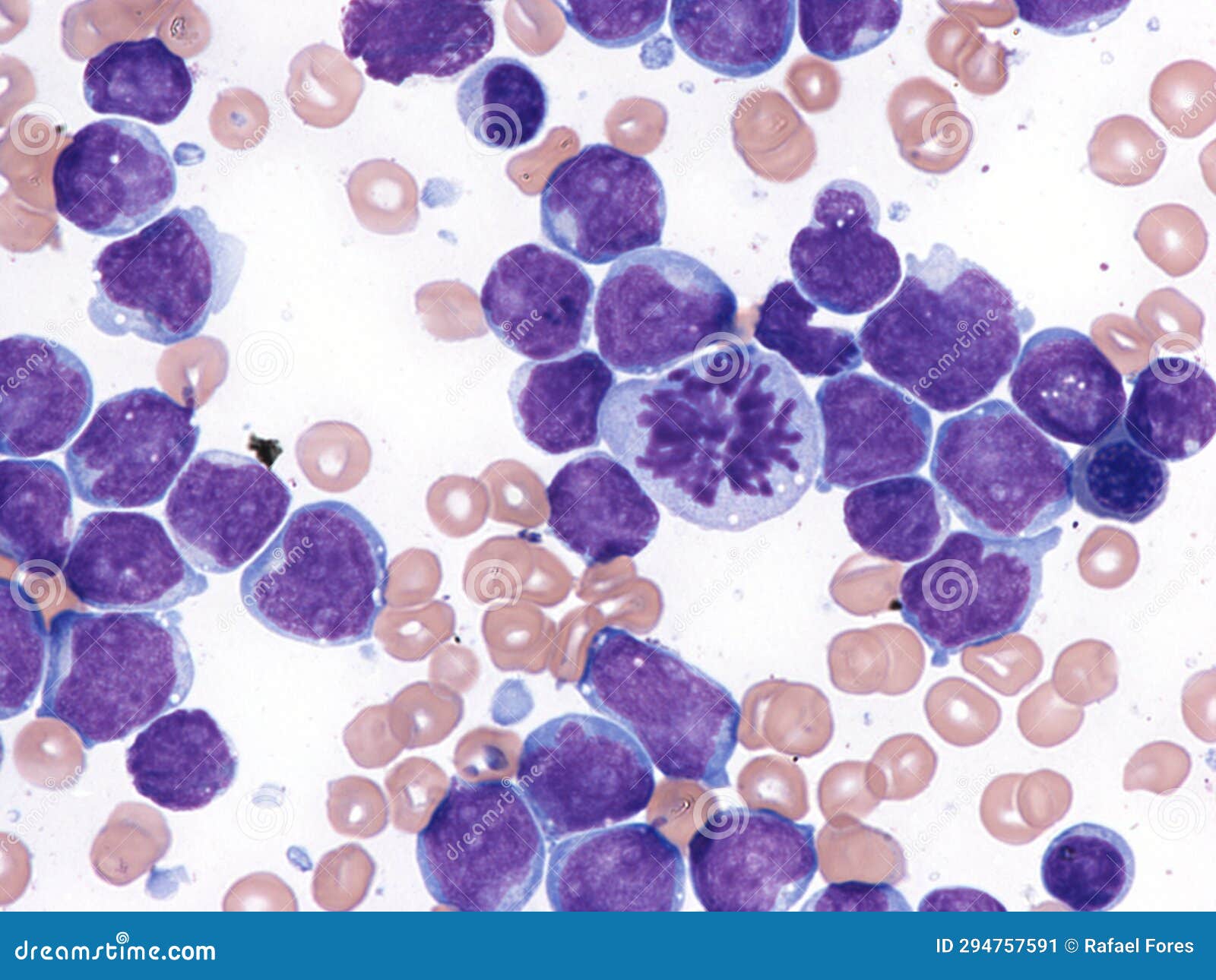 Acute Lymphoid Leukemia in Bone Marrow. Stock Image - Image of acute ...