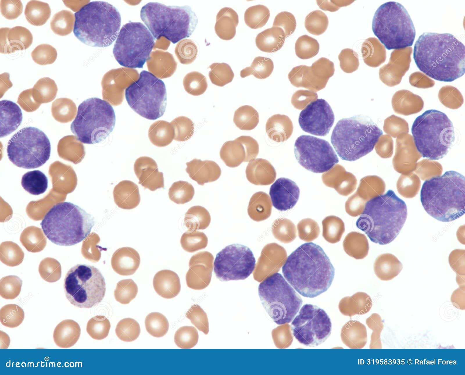 Acute Lymphoid Leukemia. Peripheral Blood. Stock Image - Image of ...