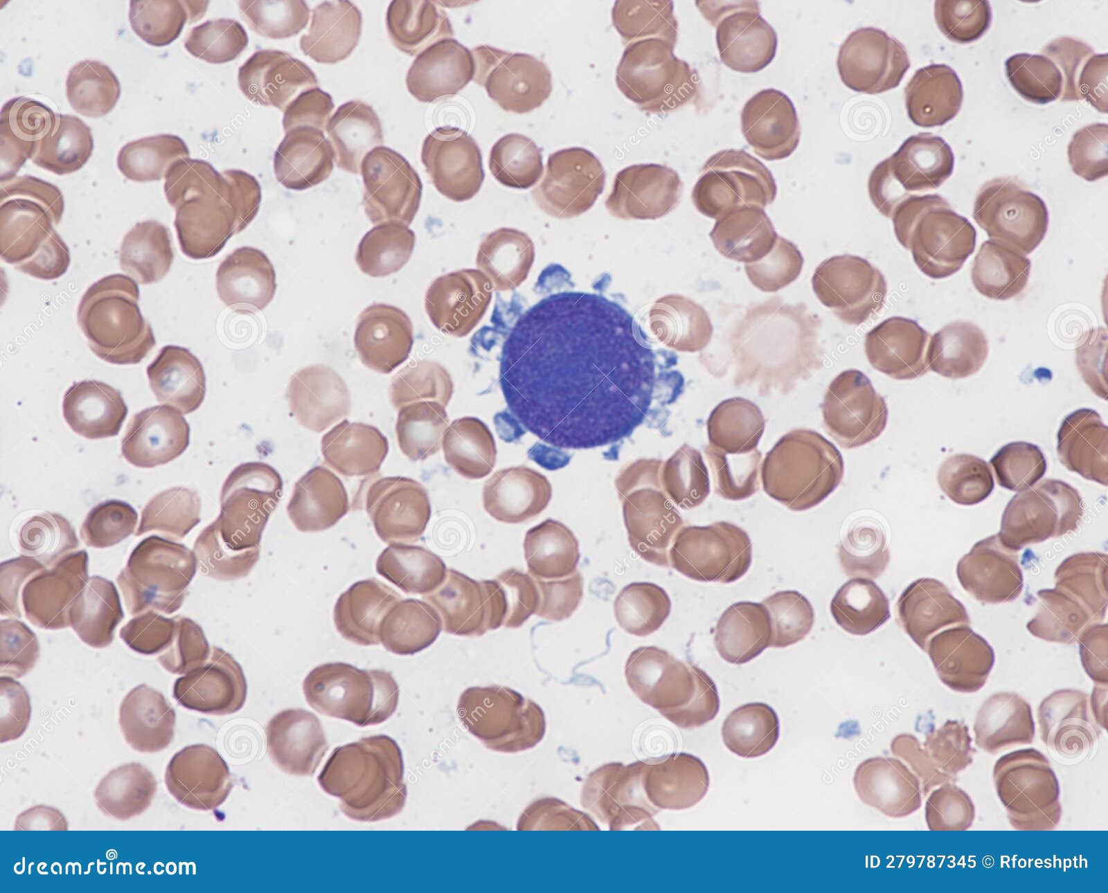 Megakaryoblast In Peripheral Blood
