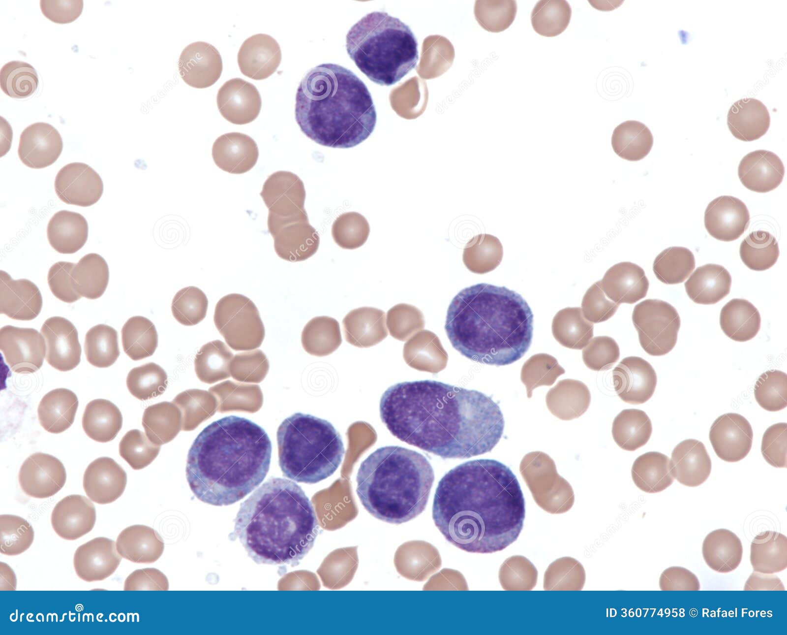 Acute Monocytic Leukemia in Bone Marrow. Stock Photo - Image of ...