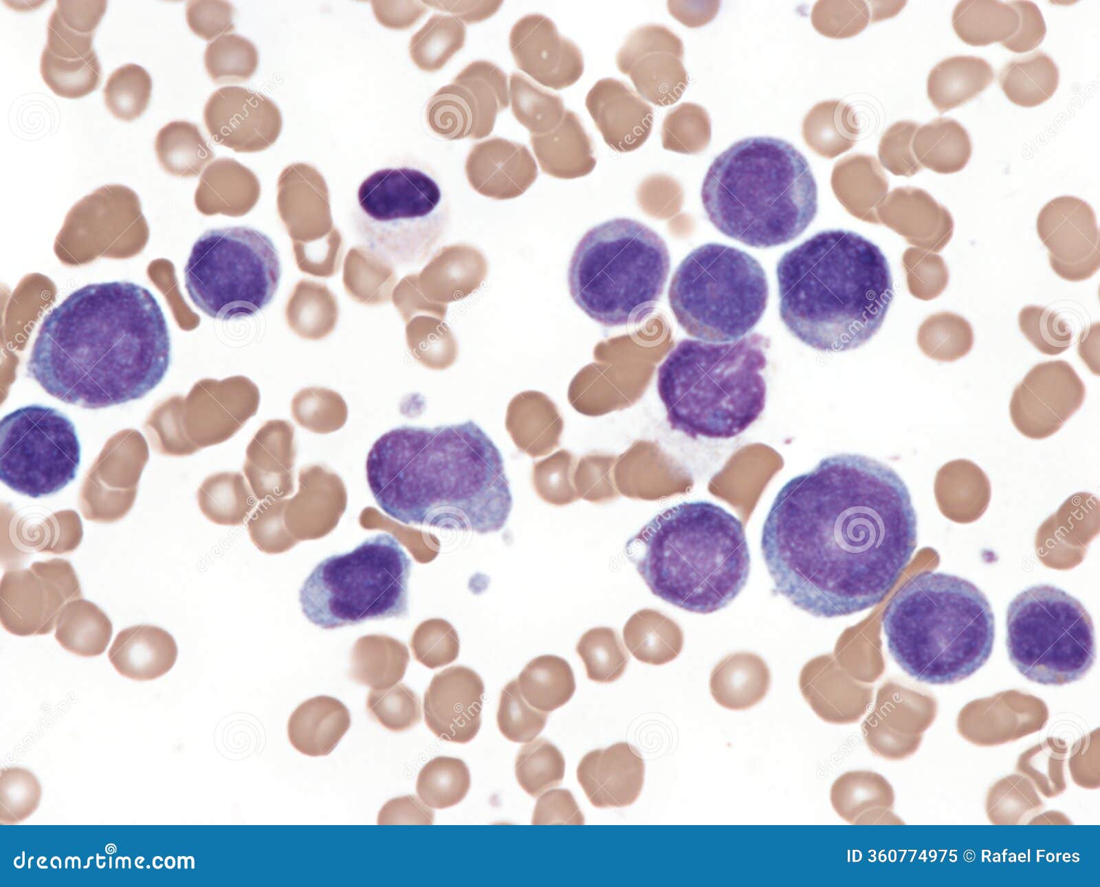Acute Monocytic Leukemia in Bone Marrow. Stock Image - Image of cancer ...