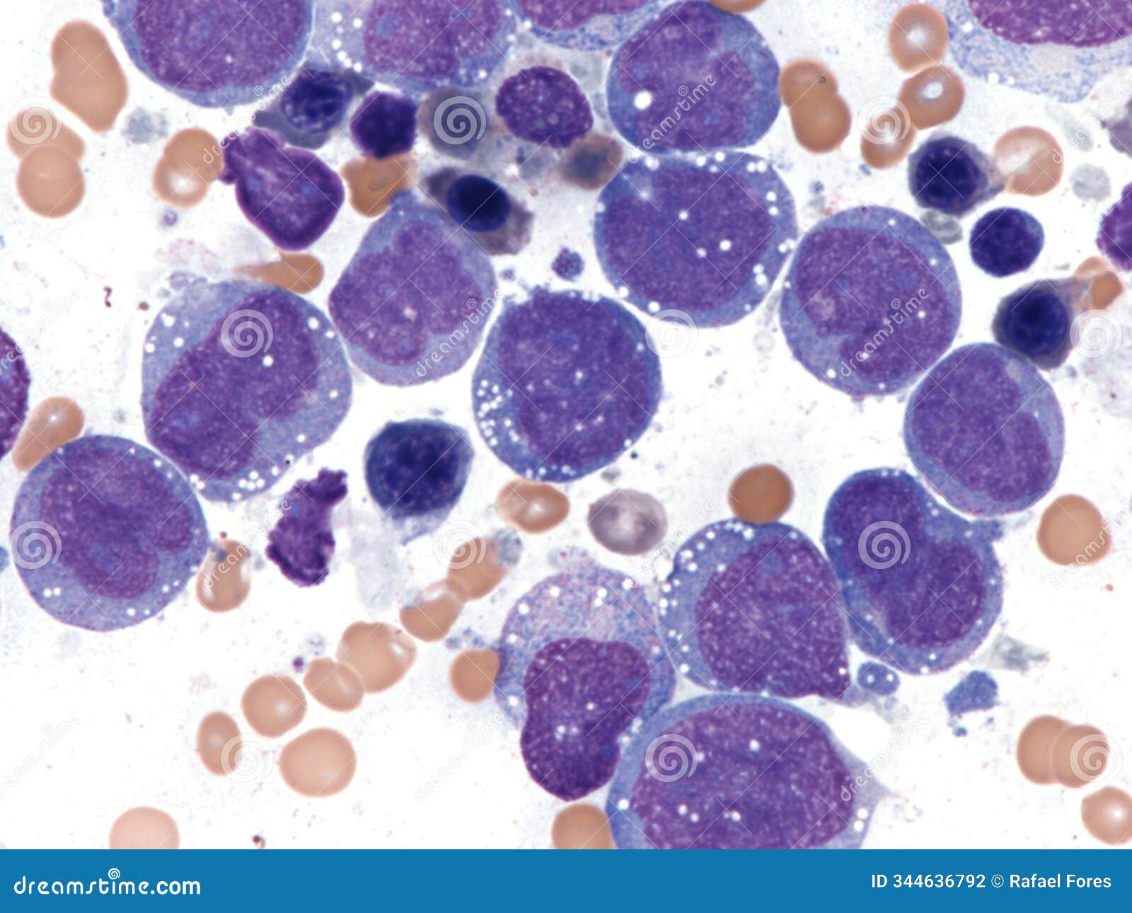 Acute Monocytic Leukemia in Bone Marrow. Stock Photo - Image of acute ...