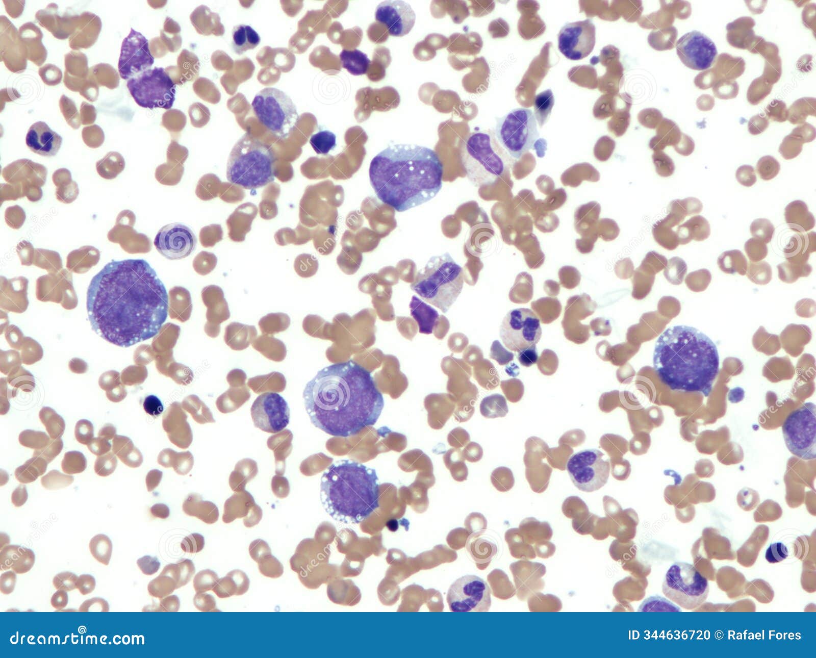 Acute Monocytic Leukemia in Bone Marrow. Stock Photo - Image of ...