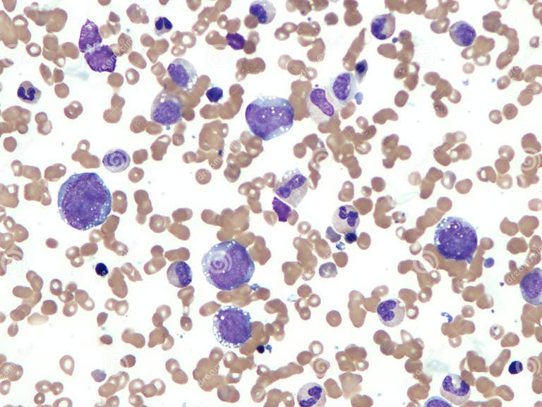Acute Monocytic Leukemia in Bone Marrow. Stock Photo - Image of ...