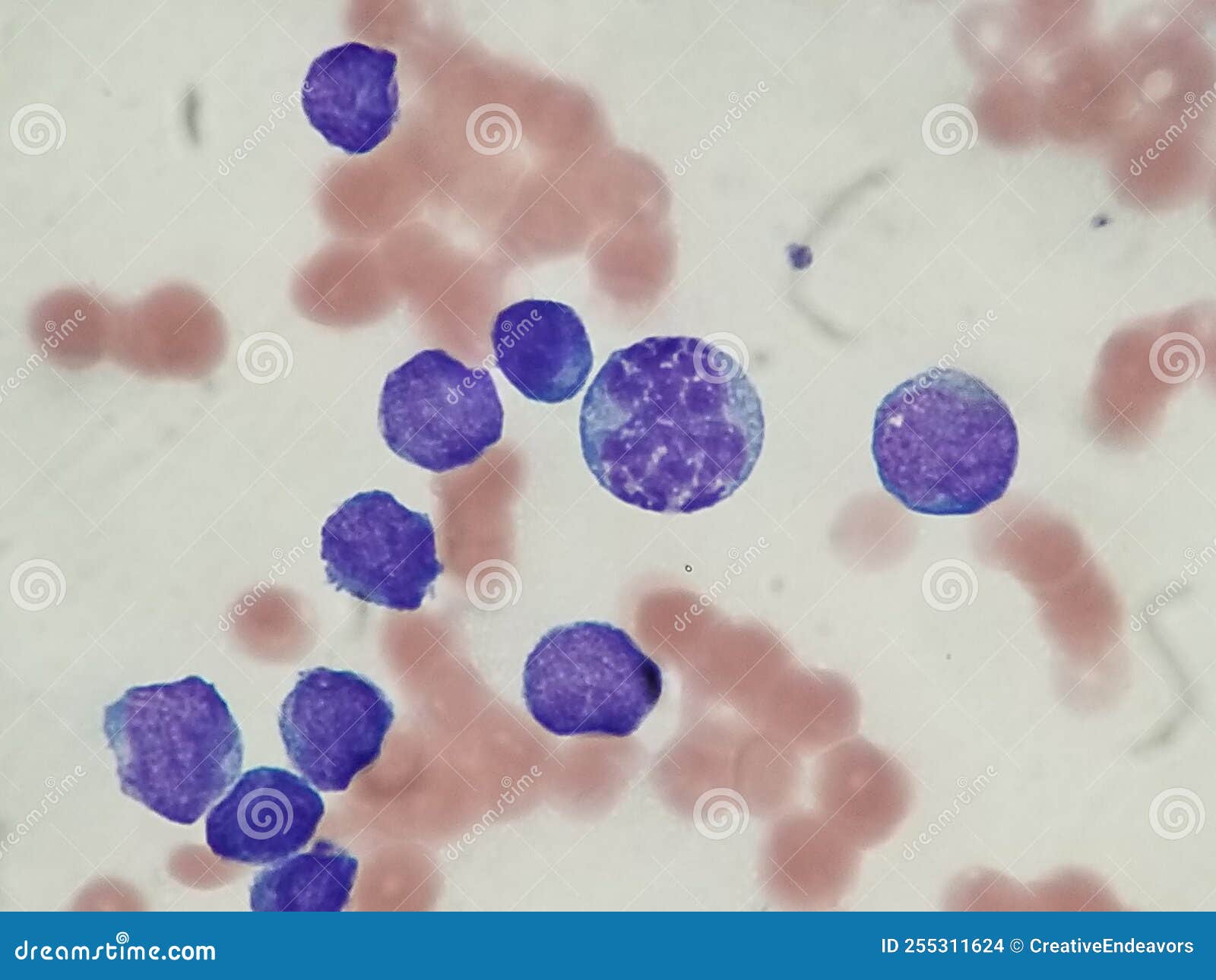 Acute Myelocytic Leukemia Seen On Peripheral Blood Smear Stock ...