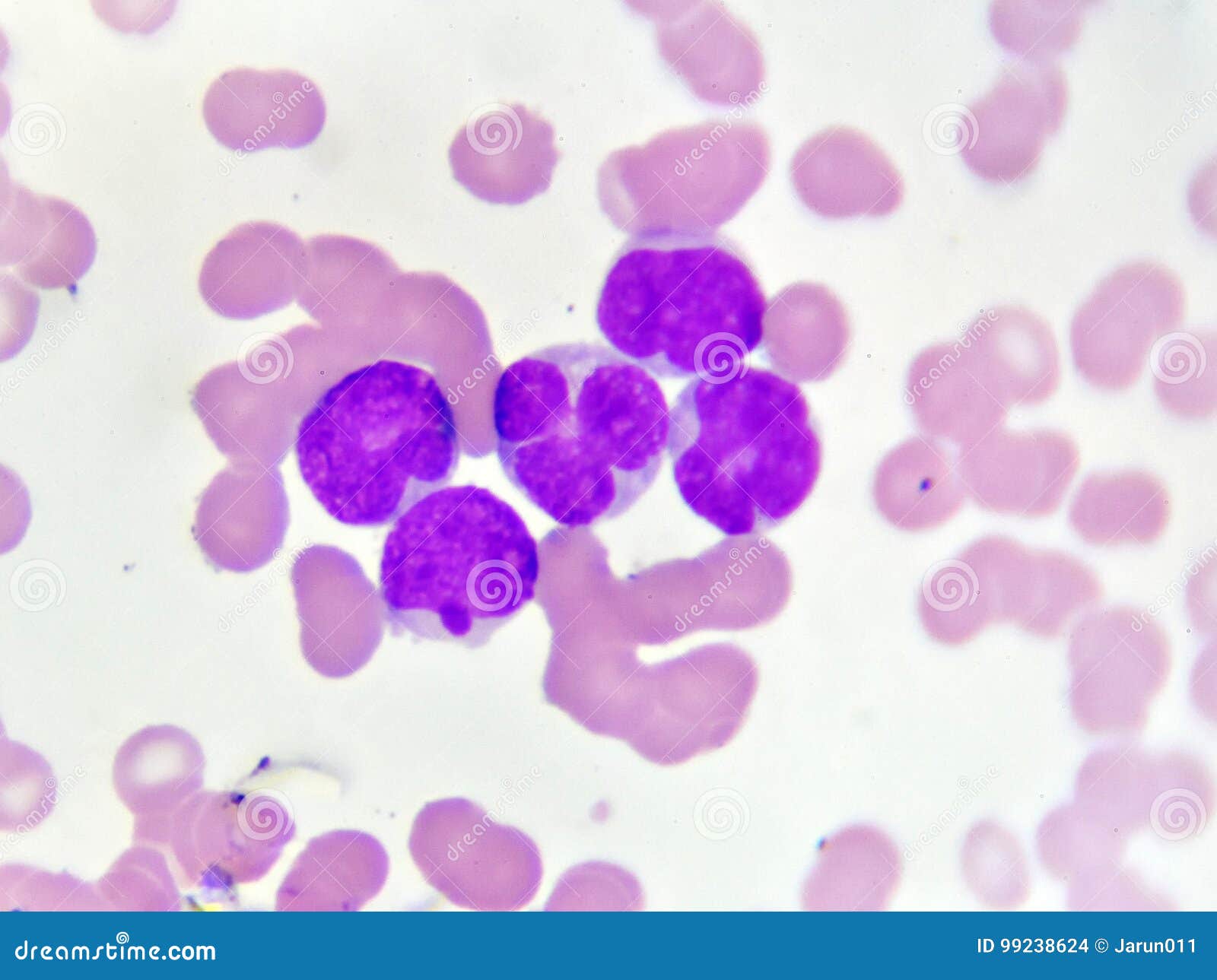Acute myeloid leukemia AML stock photo. Image of cells - 99238624