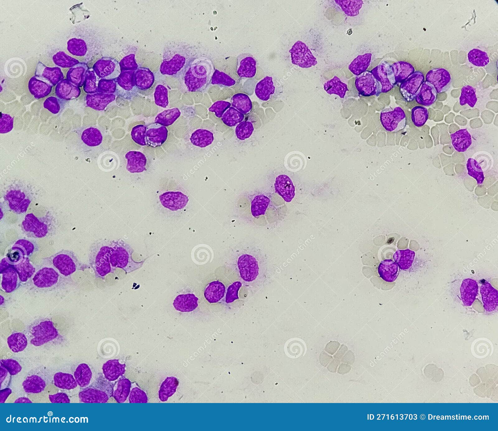 AML - Acute Myeloid Leukemia Acronym, Medical Concept Background Stock ... AML - Acute Myeloid Leukemia Acronym, Medical Concept Background Stock ...
