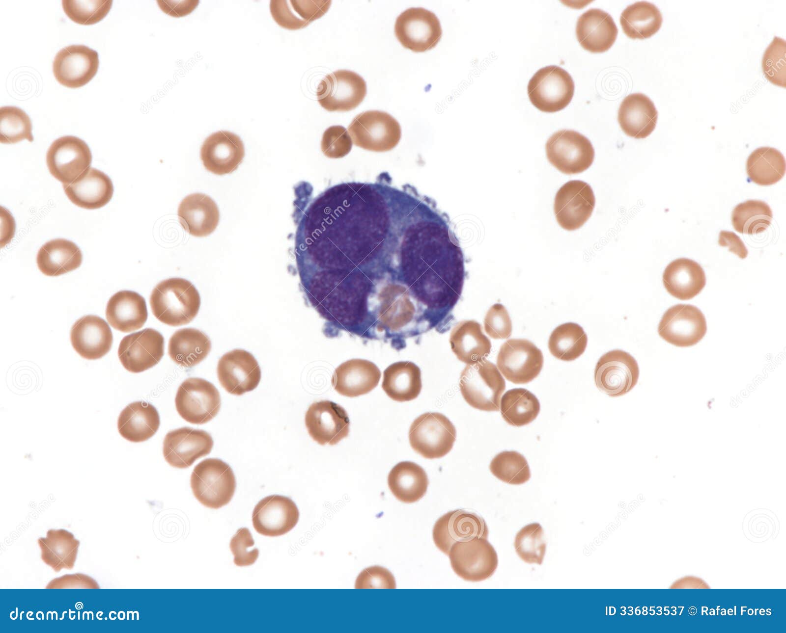 Acute Myeloid Leukemia Aml Smear Show Monocytes And Mostly Blast