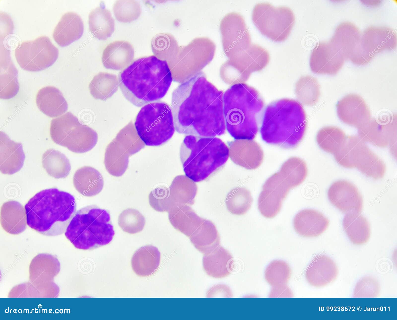Acute myeloid leukemia stock photo. Image of basophil - 99238672