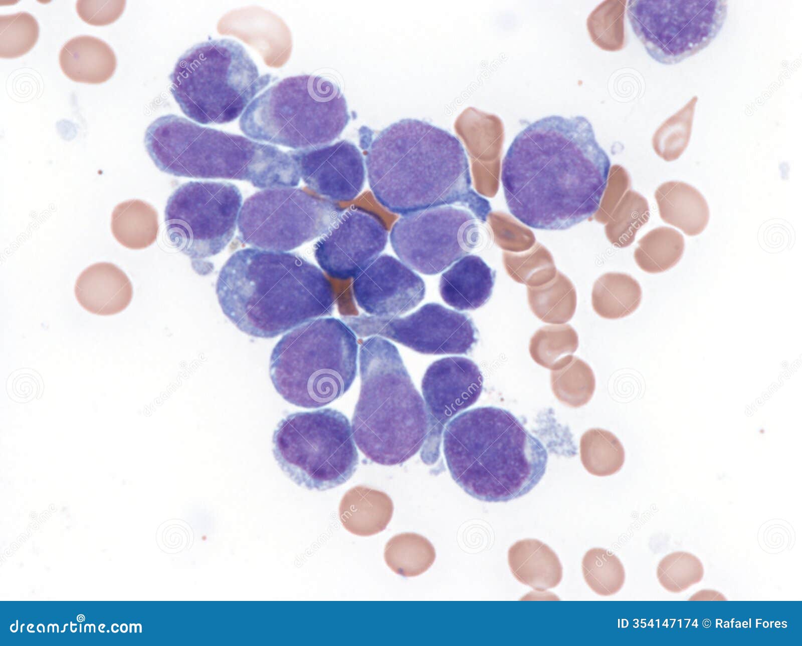 Acute Myeloid Leukemia with Proliferation of Dendritic Cells. Stock ...