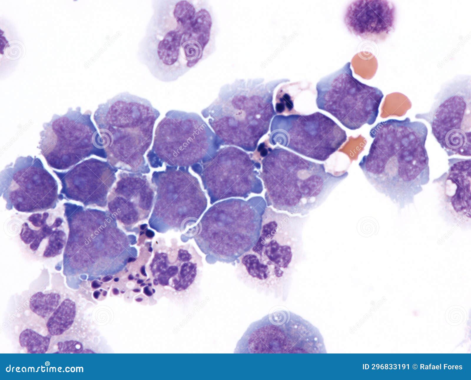 Acute Myeloid Leukemia Aml Smear Show Monocytes And Mostly Blast Cells Royalty Free Stock