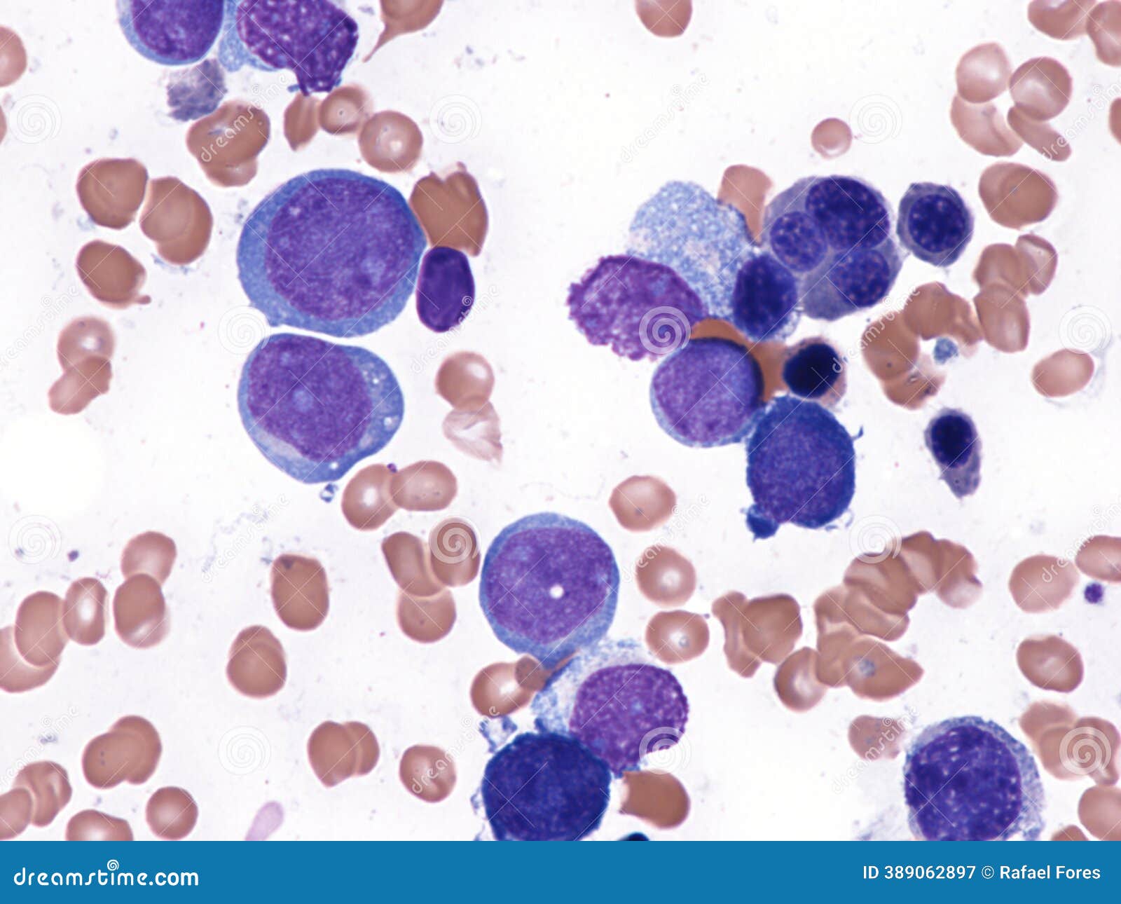 Acute Myeloid Leukemia With Meningeal Involvement. Royalty-Free Stock ...