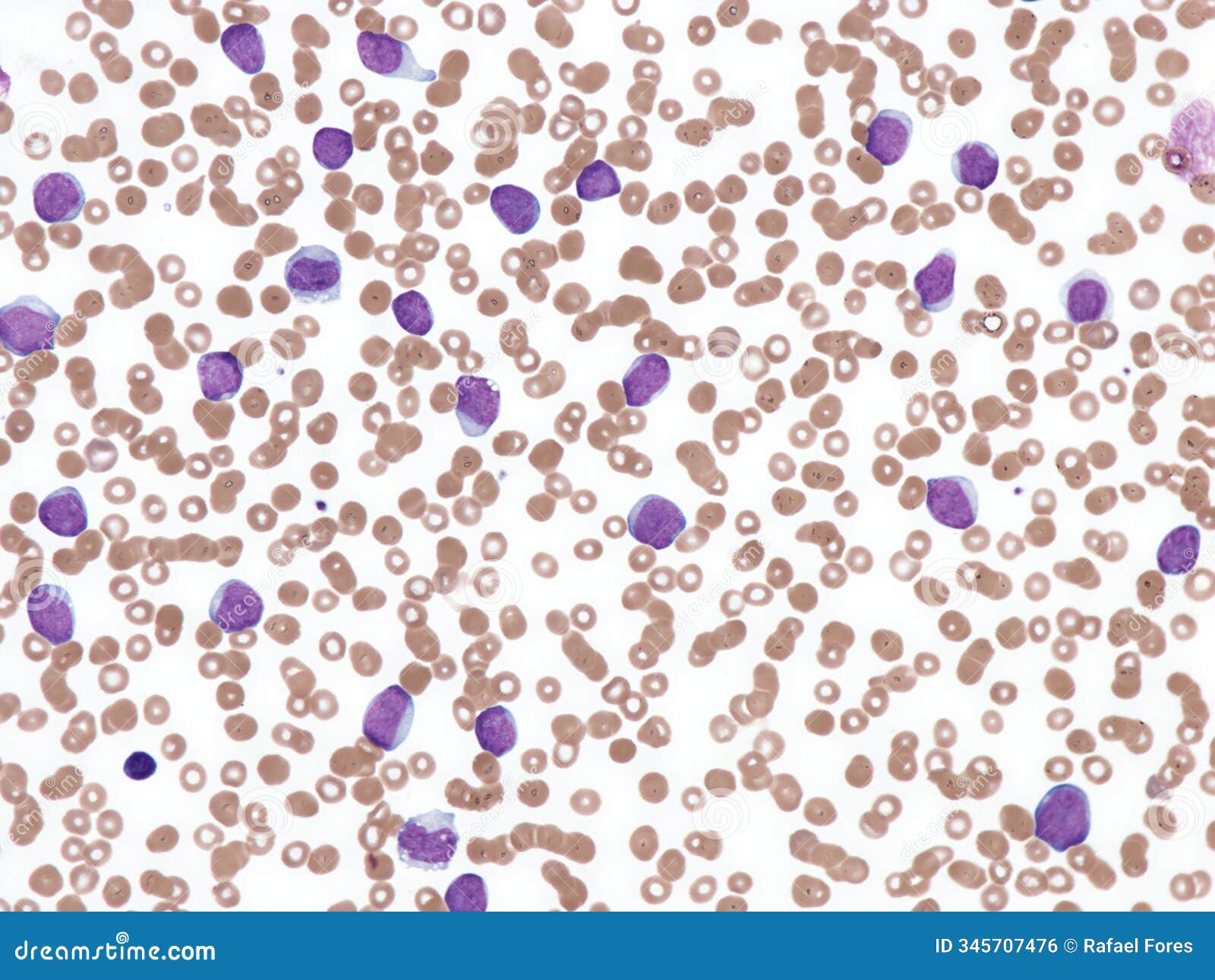 AML - Acute Myeloid Leukemia Acronym, Medical Concept Background Stock ... AML - Acute Myeloid Leukemia Acronym, Medical Concept Background Stock ...