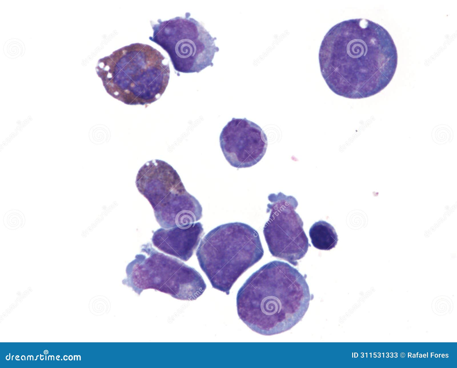 Acute Myeloid Leukemia in Pleural Fluid. Stock Image - Image of ...