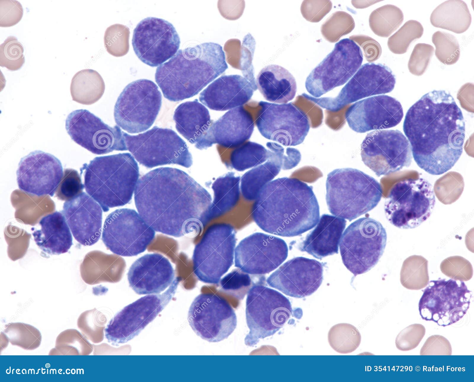 Acute Myeloid Leukemia with Proliferation of Dendritic Cells. Stock ...