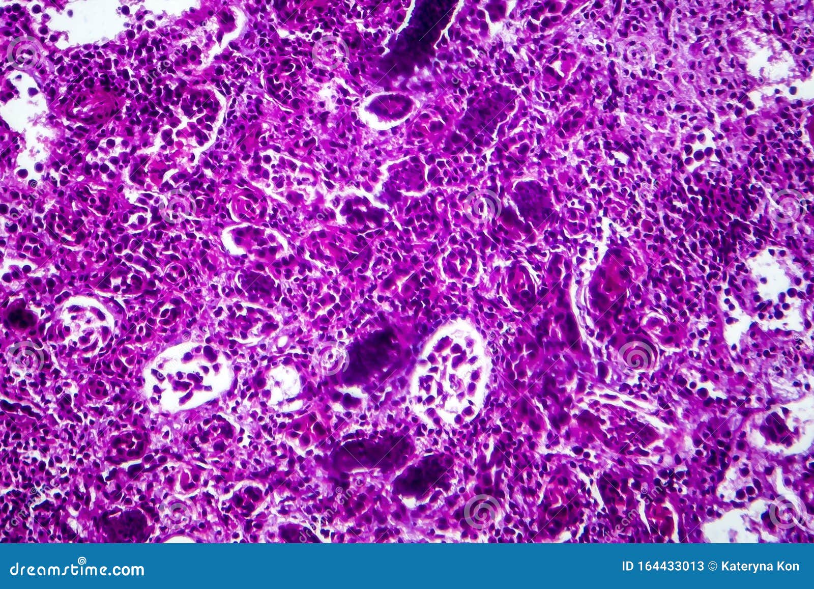 Acute Nephritis, Light Micrograph Stock Image - Image of medicine ...
