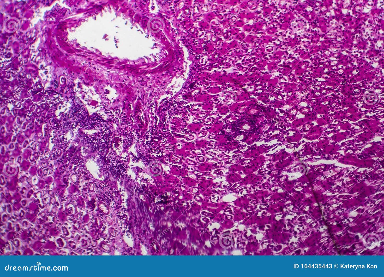 Acute Nephritis, Light Micrograph Stock Image - Image of disease ...