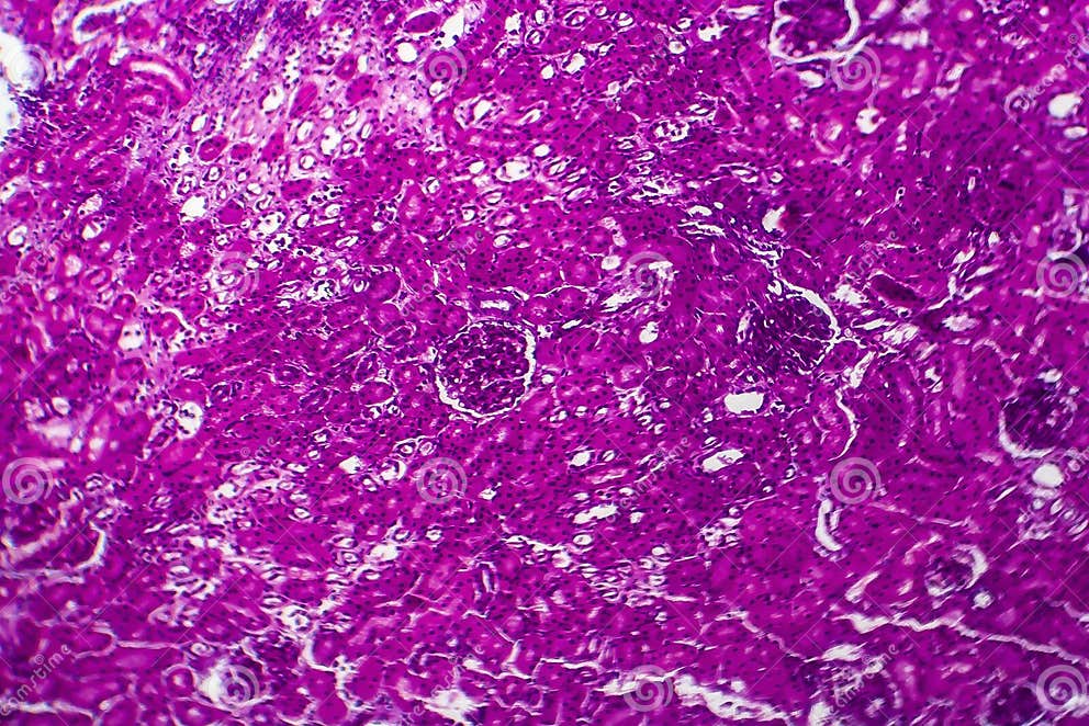 Acute Nephritis, Light Micrograph Stock Image - Image of infection ...