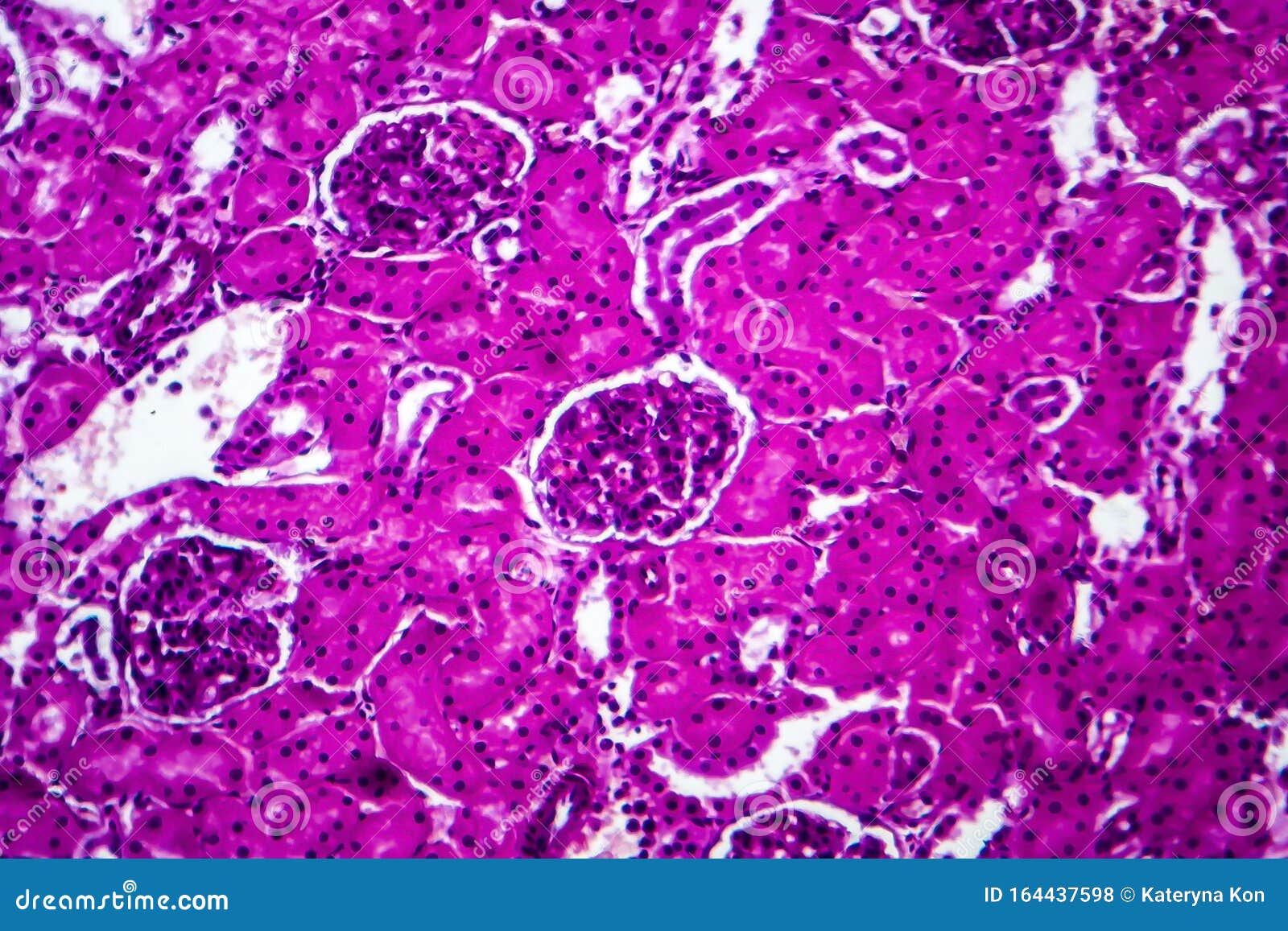 Acute Nephritis, Light Micrograph Stock Photo - Image of morphological ...