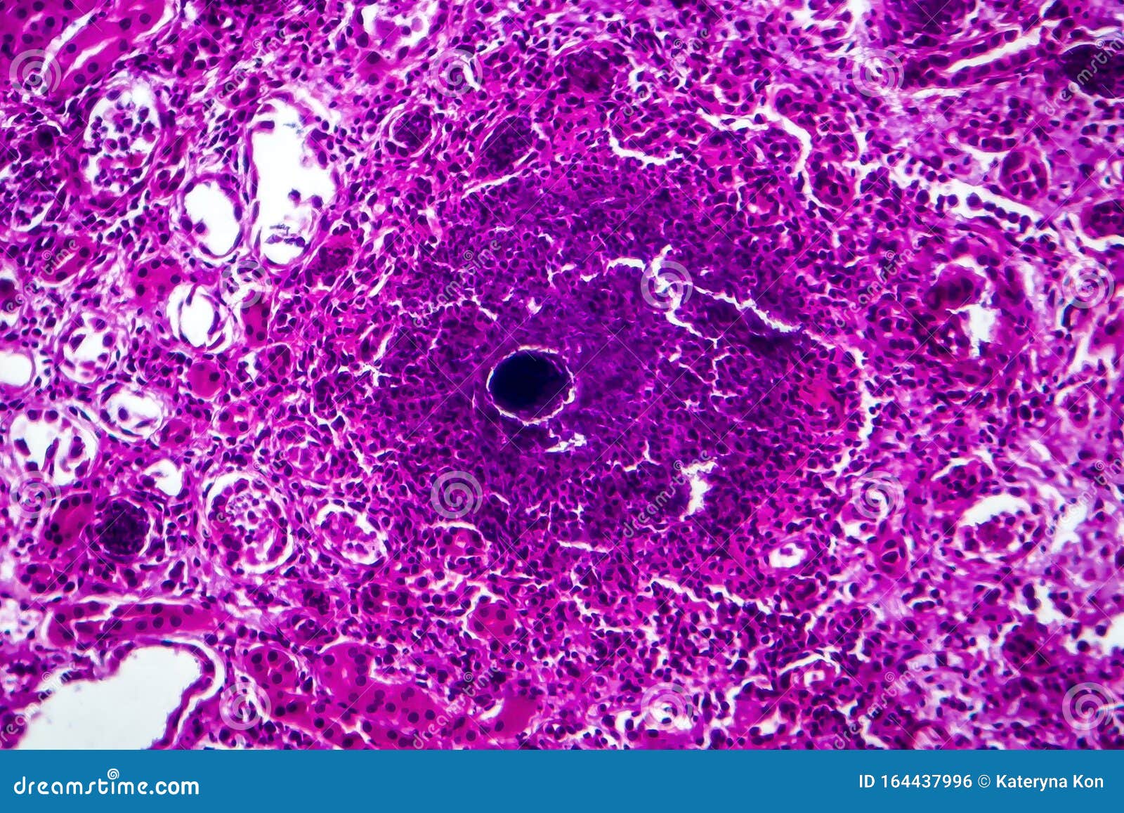 Acute Nephritis, Light Micrograph Stock Photo | CartoonDealer.com ...