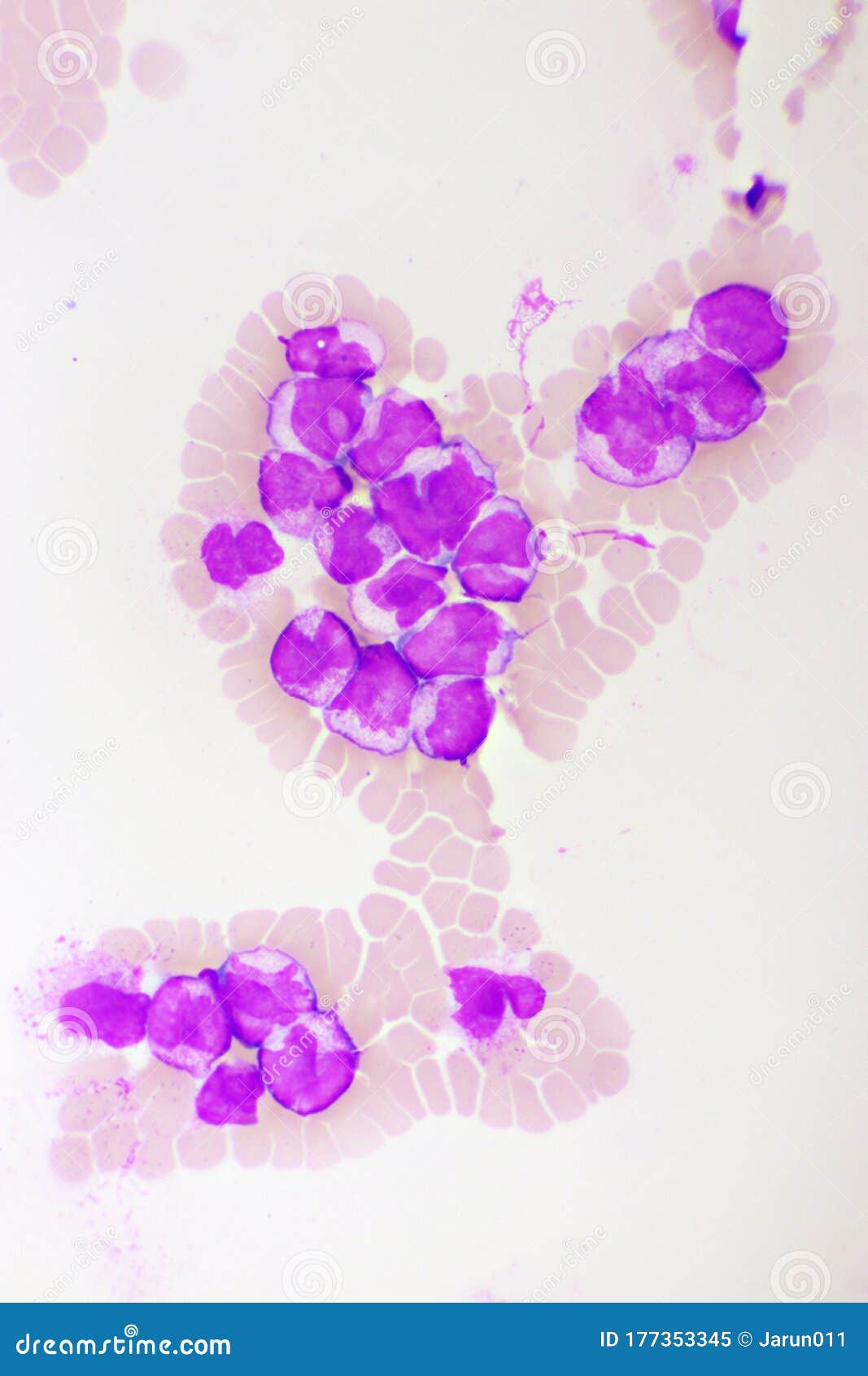 Acute Promyelocytic Leukemia Cells or APL Stock Image - Image of ... Acute Promyelocytic Leukemia Cells or APL Stock Image - Image of ...