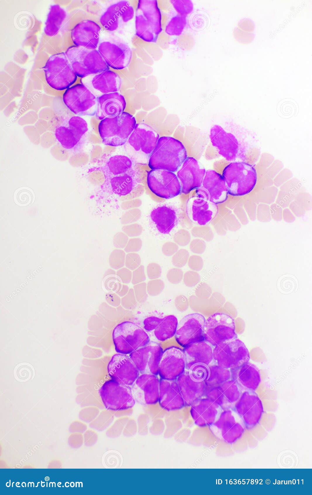 Acute Promyelocytic Leukemia Cells or APL Stock Photo - Image of cell ...