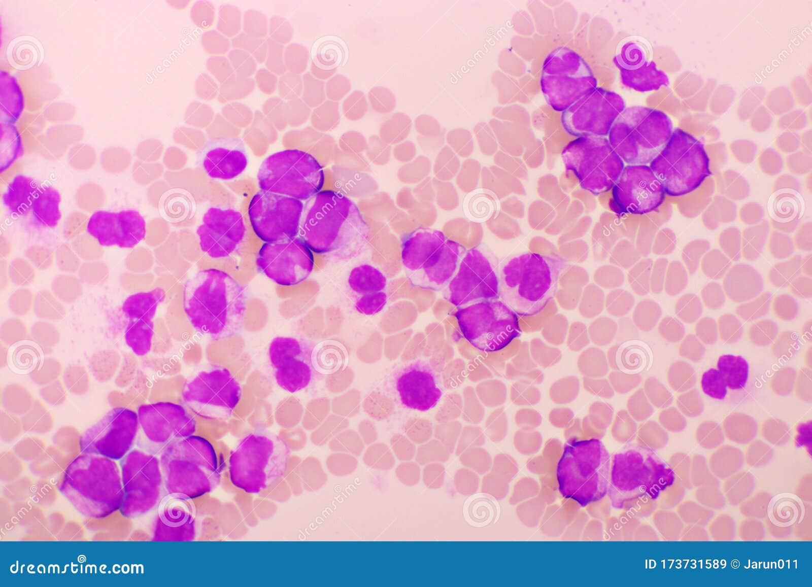 Acute Promyelocytic Leukemia Cells or APL Stock Image - Image of ...