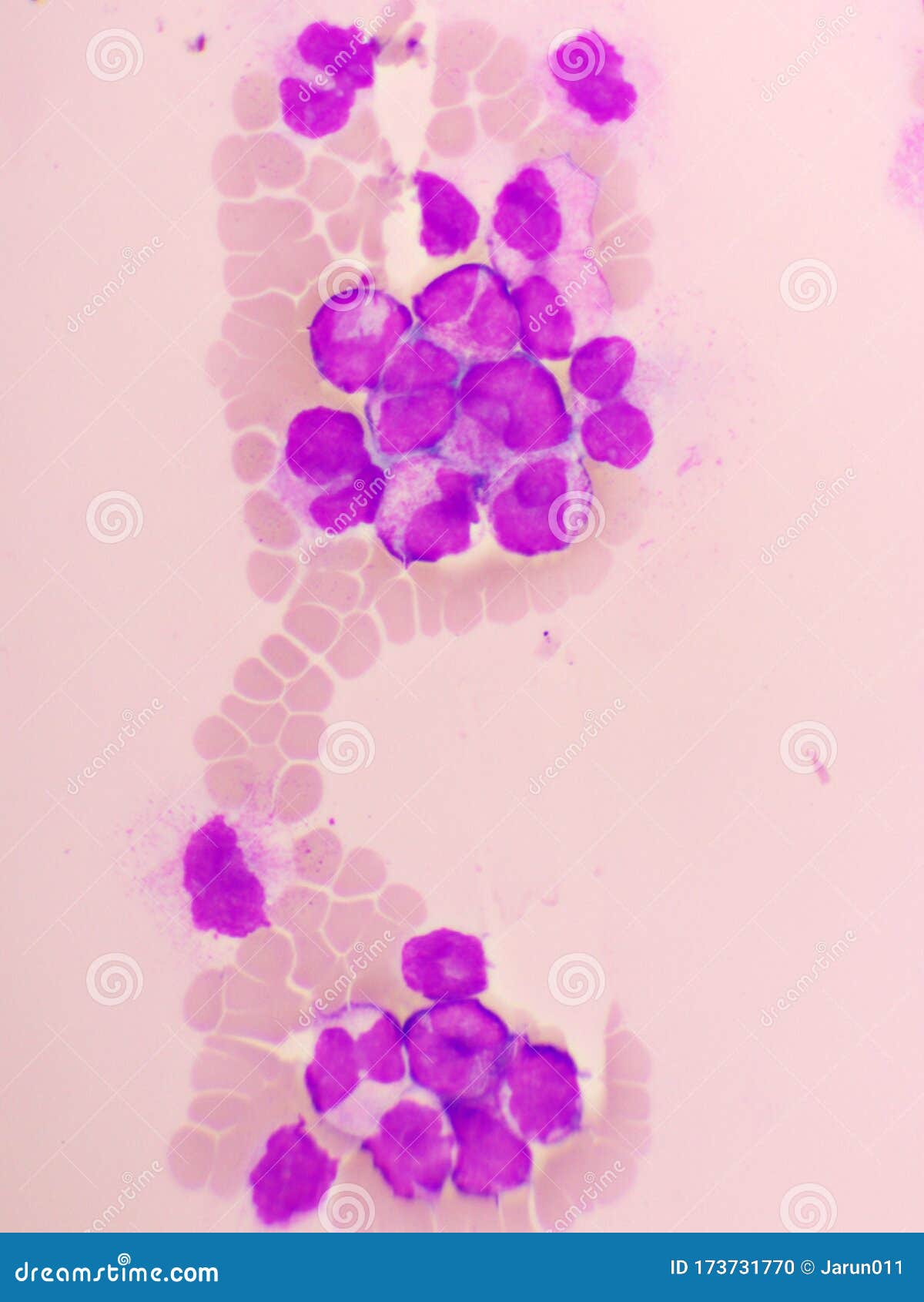 Acute Promyelocytic Leukemia Cells or APL Stock Photo - Image of ... Acute Promyelocytic Leukemia Cells or APL Stock Photo - Image of ...