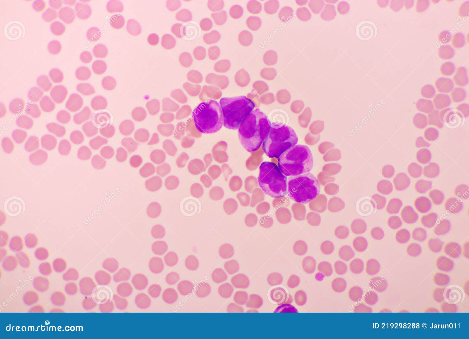 Acute Promyelocytic Leukemia Cells or APL Stock Photo - Image of blast ...