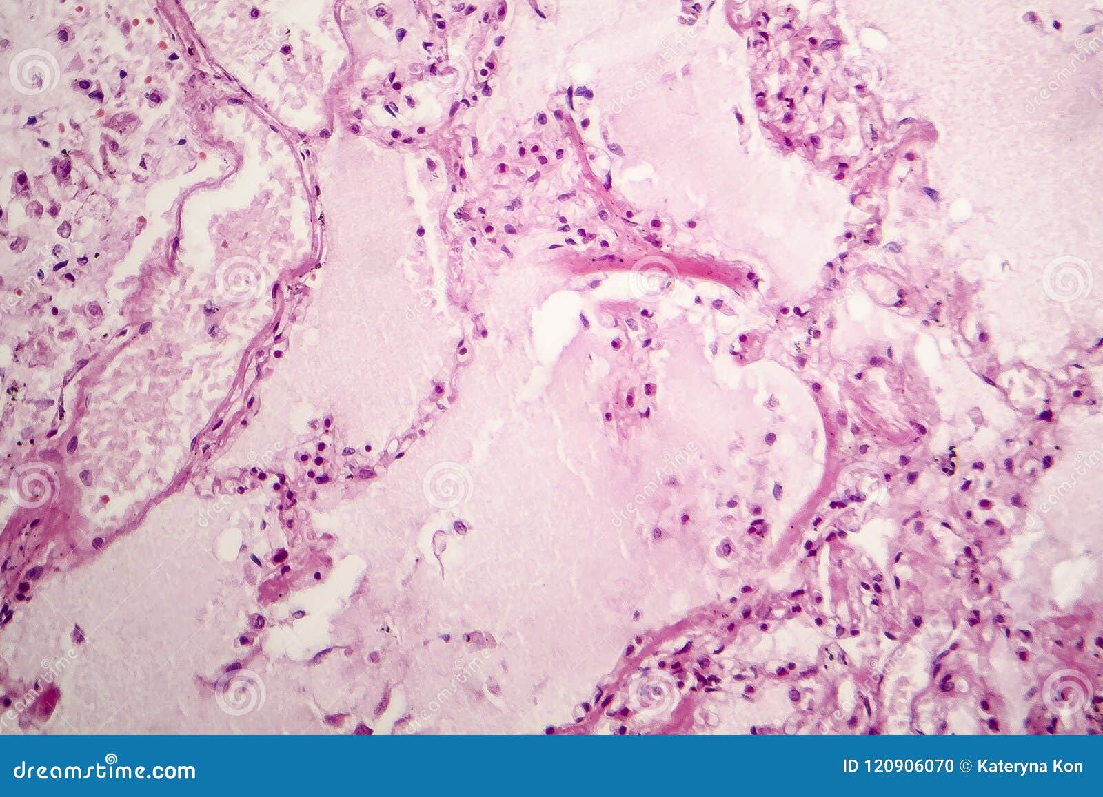 Acute pulmonary edema stock photo. Image of photomicrograph - 120906070