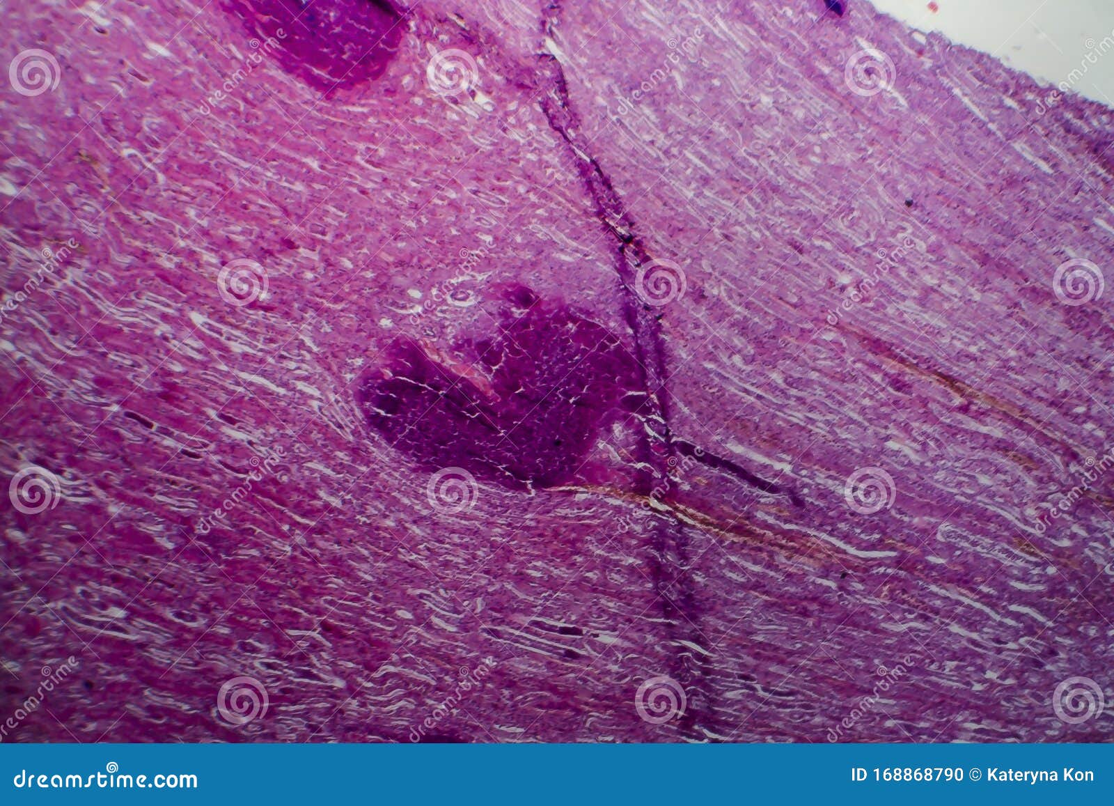 Acute Pyelonephritis, Light Micrograph Stock Photo - Image of pathology ...