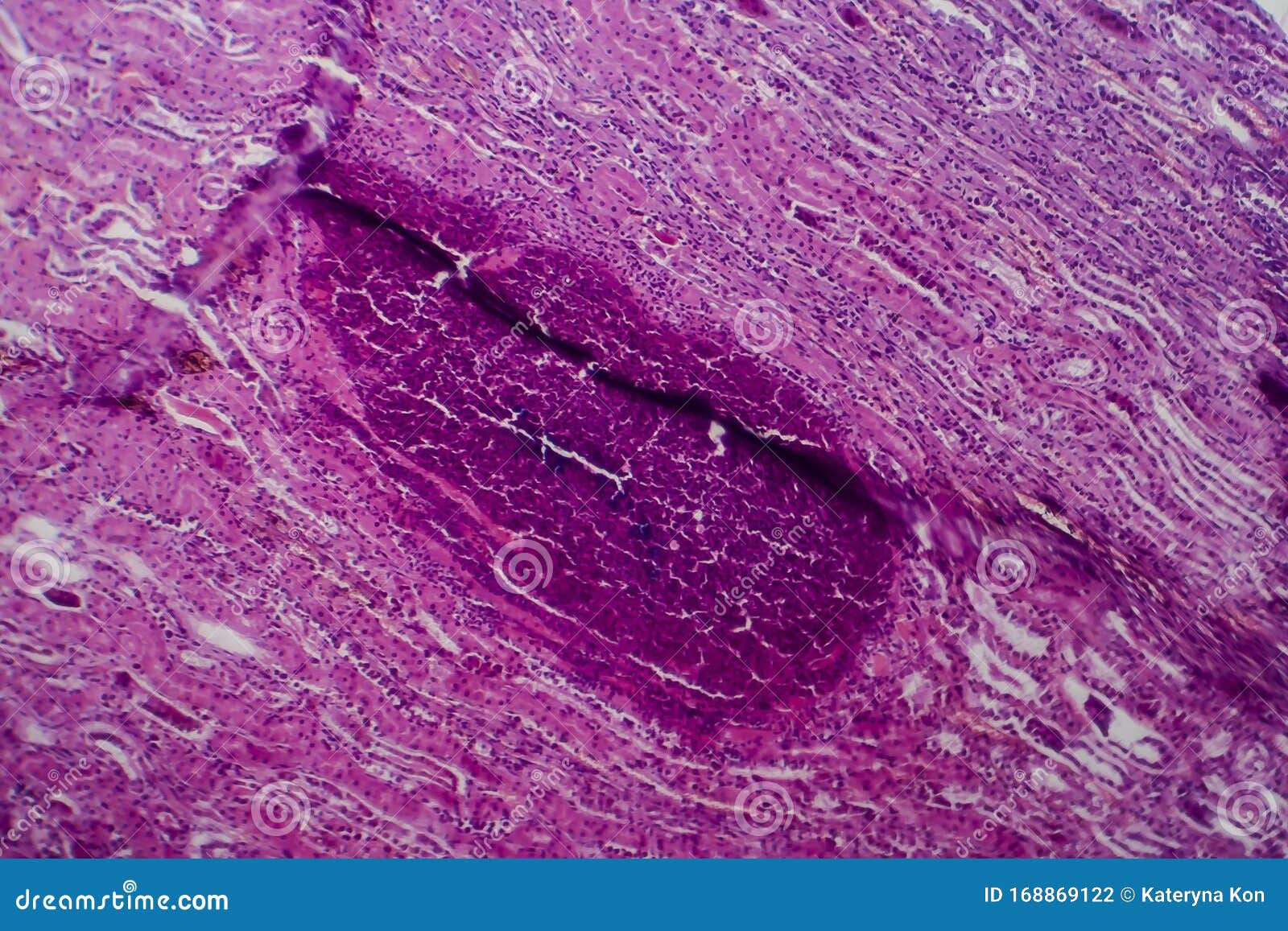 Acute Pyelonephritis, Light Micrograph Stock Photo - Image of disease ...