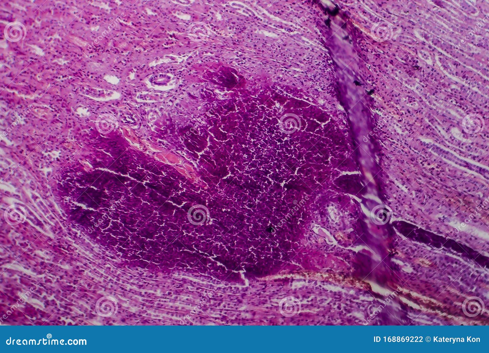 Acute Pyelonephritis, Light Micrograph Stock Photo - Image of ...