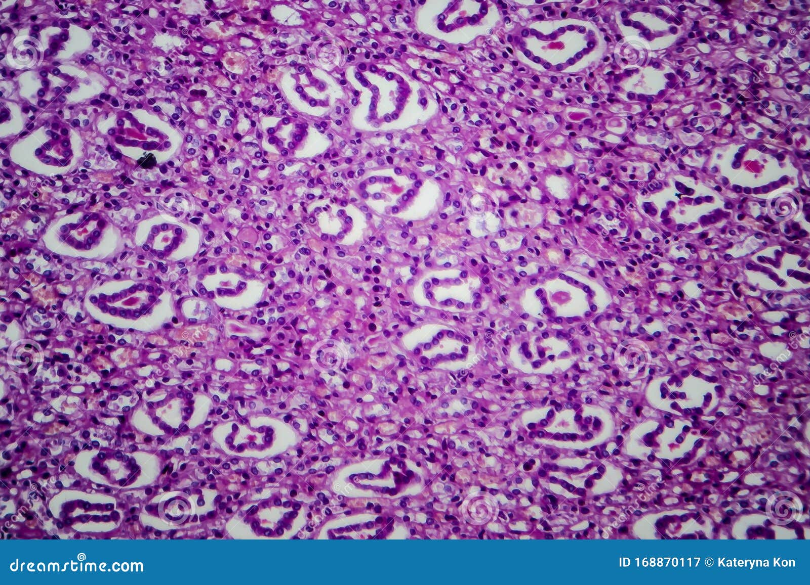 Acute Pyelonephritis, Light Micrograph Stock Image - Image of kidney ...