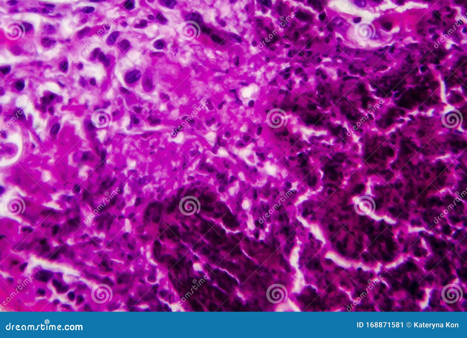 Acute Pyelonephritis, Light Micrograph Stock Image - Image of renal ...
