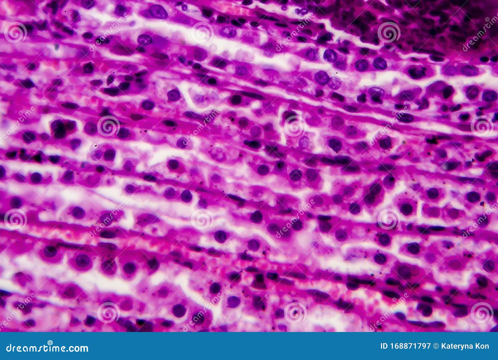 Acute Pyelonephritis, Light Micrograph Stock Image - Image of ...