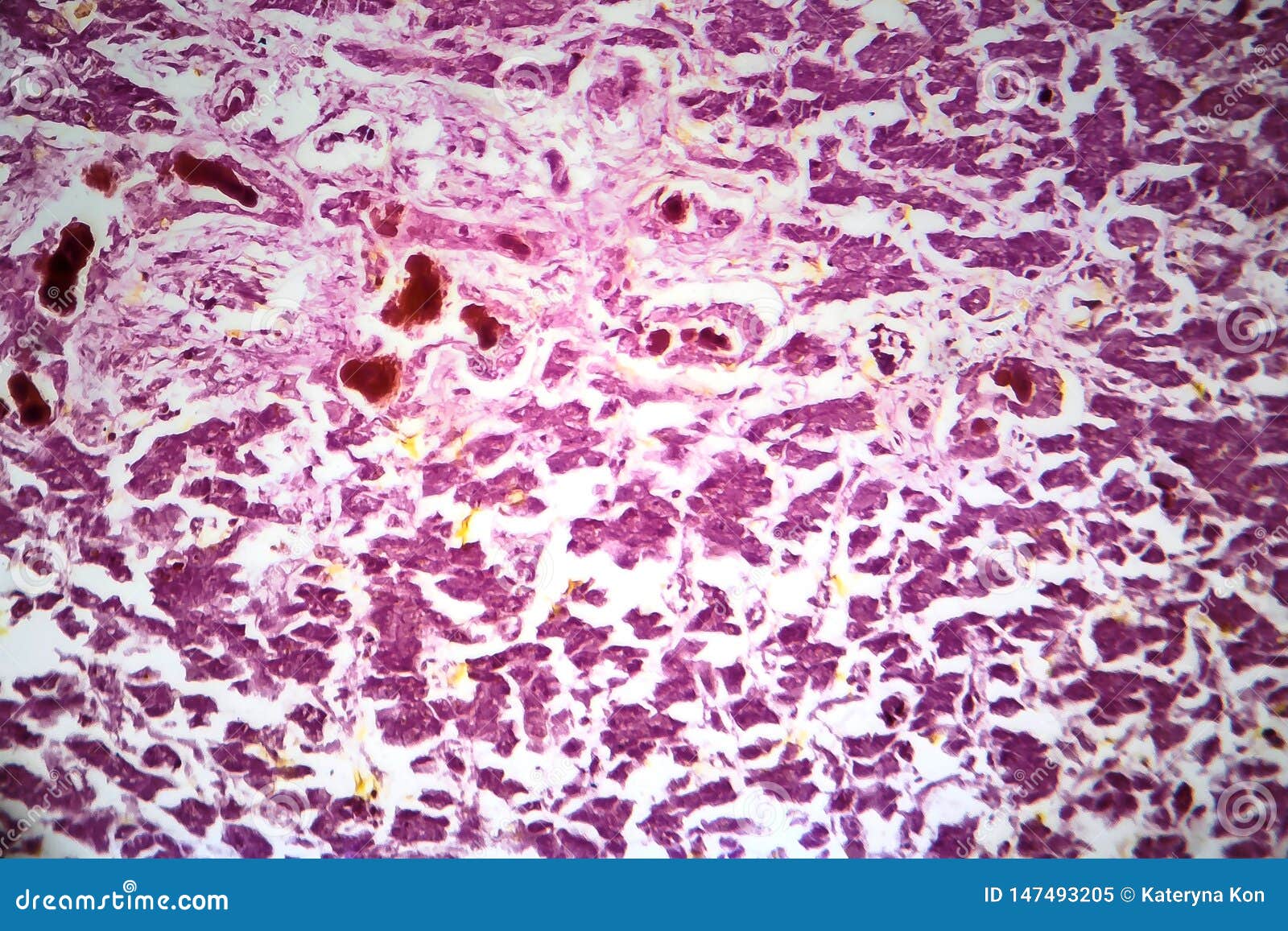 Severe Acute Hepatitis Stock Photos - Free & Royalty-Free Stock Photos ... Severe Acute Hepatitis Stock Photos - Free & Royalty-Free Stock Photos ...