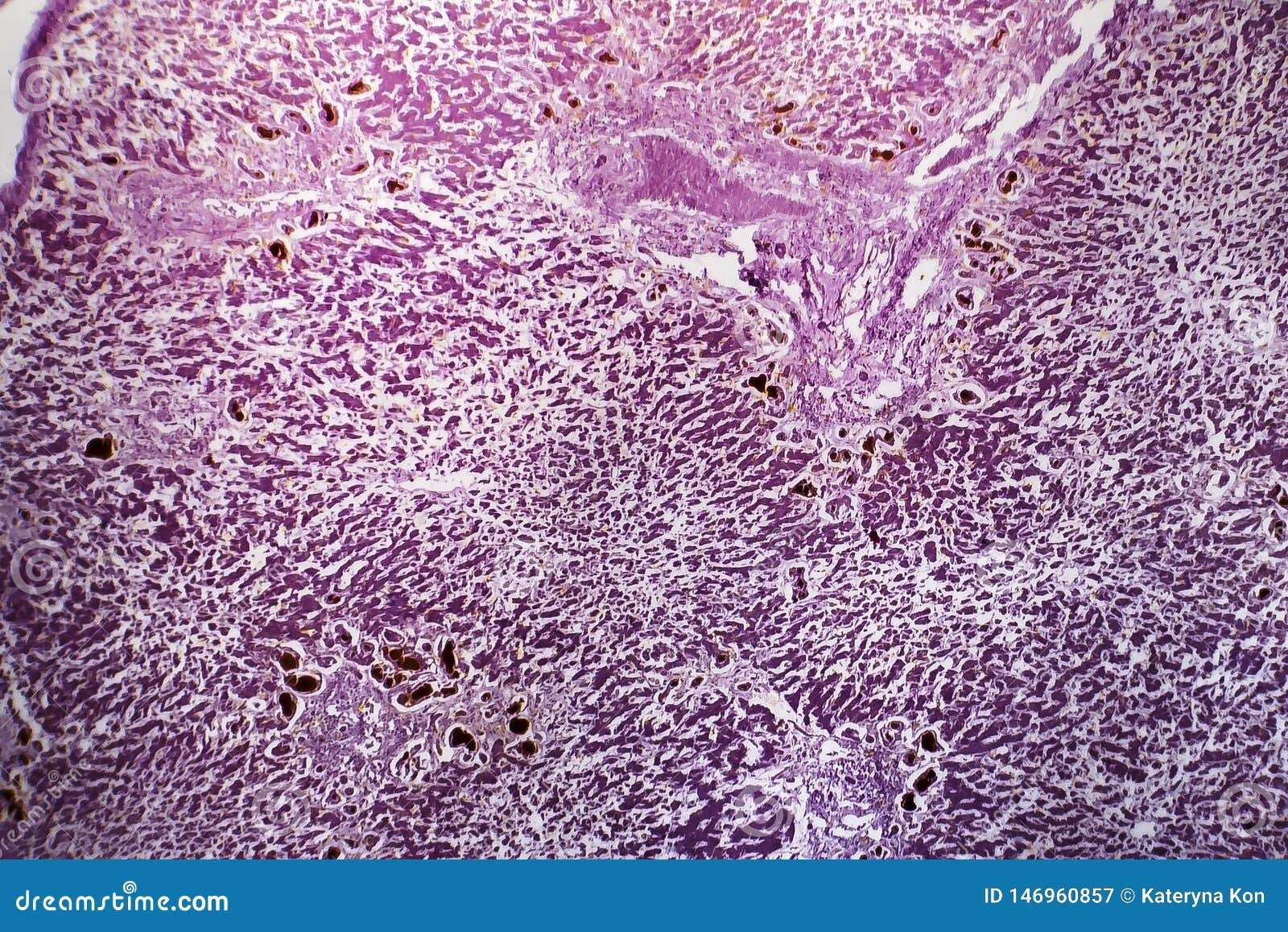 Acute Severe Hepatitis, Light Micrograph Stock Image | CartoonDealer ... Acute Severe Hepatitis, Light Micrograph Stock Image | CartoonDealer ...