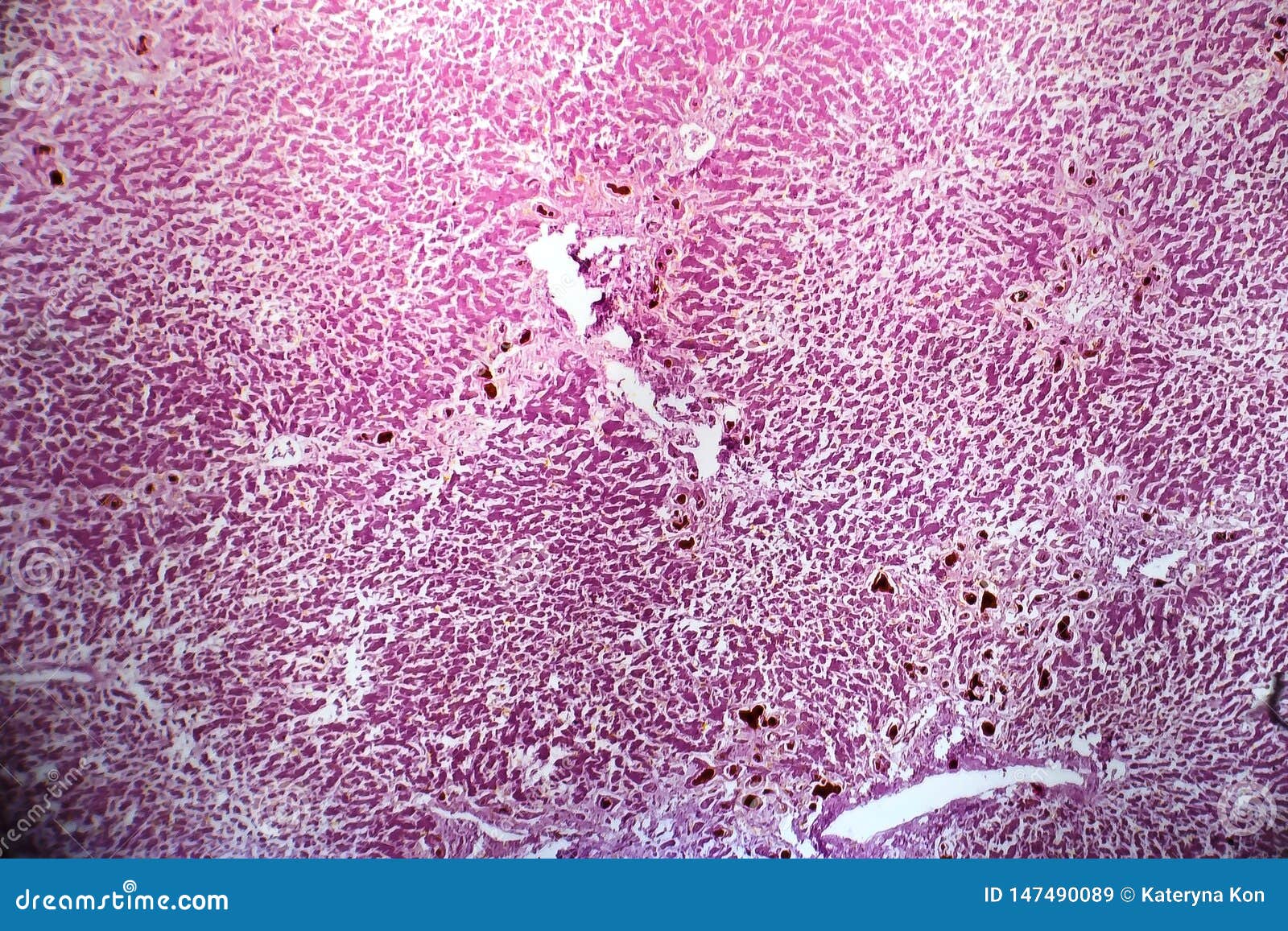 Acute Severe Hepatitis, Light Micrograph Royalty-Free Stock Photography ... Acute Severe Hepatitis, Light Micrograph Royalty-Free Stock Photography ...