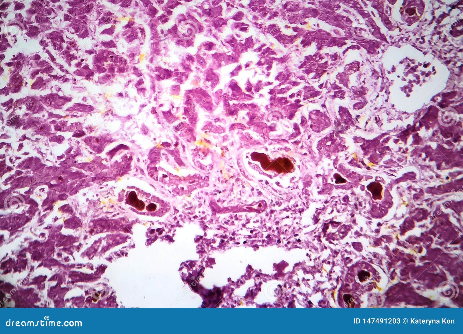 Acute Severe Hepatitis, Light Micrograph Stock Image | CartoonDealer ... Acute Severe Hepatitis, Light Micrograph Stock Image | CartoonDealer ...