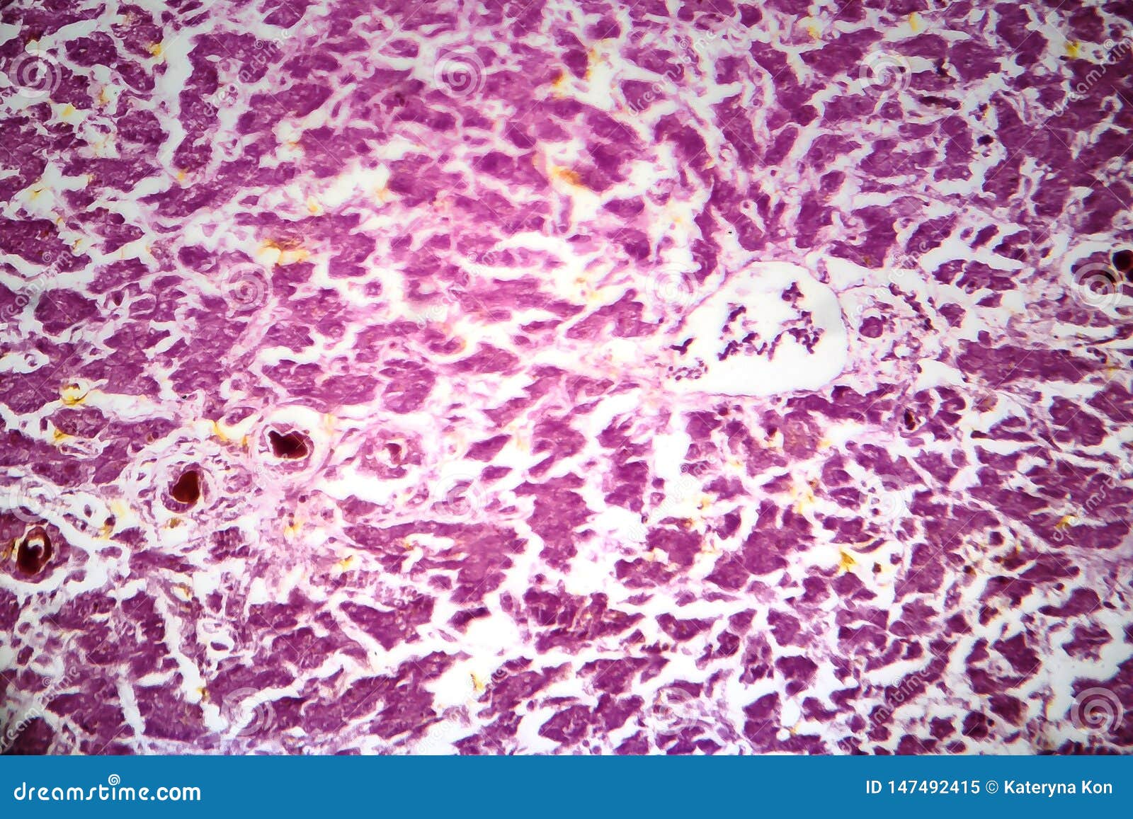 Acute Severe Hepatitis, Light Micrograph Royalty-Free Stock Photography ... Acute Severe Hepatitis, Light Micrograph Royalty-Free Stock Photography ...