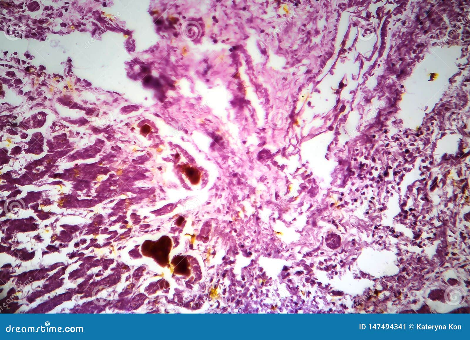 Acute Severe Hepatitis, Light Micrograph Royalty-Free Stock Photography ...