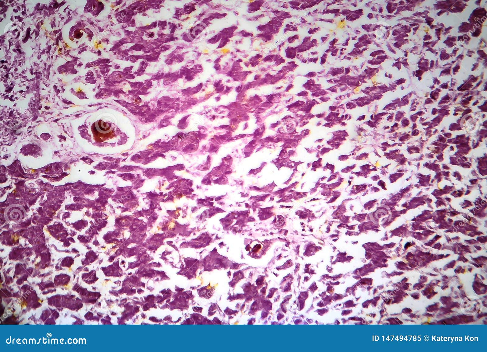 Acute Severe Hepatitis, Light Micrograph Royalty-Free Stock Photo ... Acute Severe Hepatitis, Light Micrograph Royalty-Free Stock Photo ...