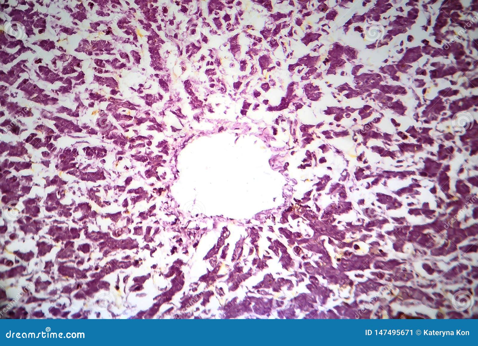 Acute Severe Hepatitis, Light Micrograph Royalty-Free Stock Photography ... Acute Severe Hepatitis, Light Micrograph Royalty-Free Stock Photography ...