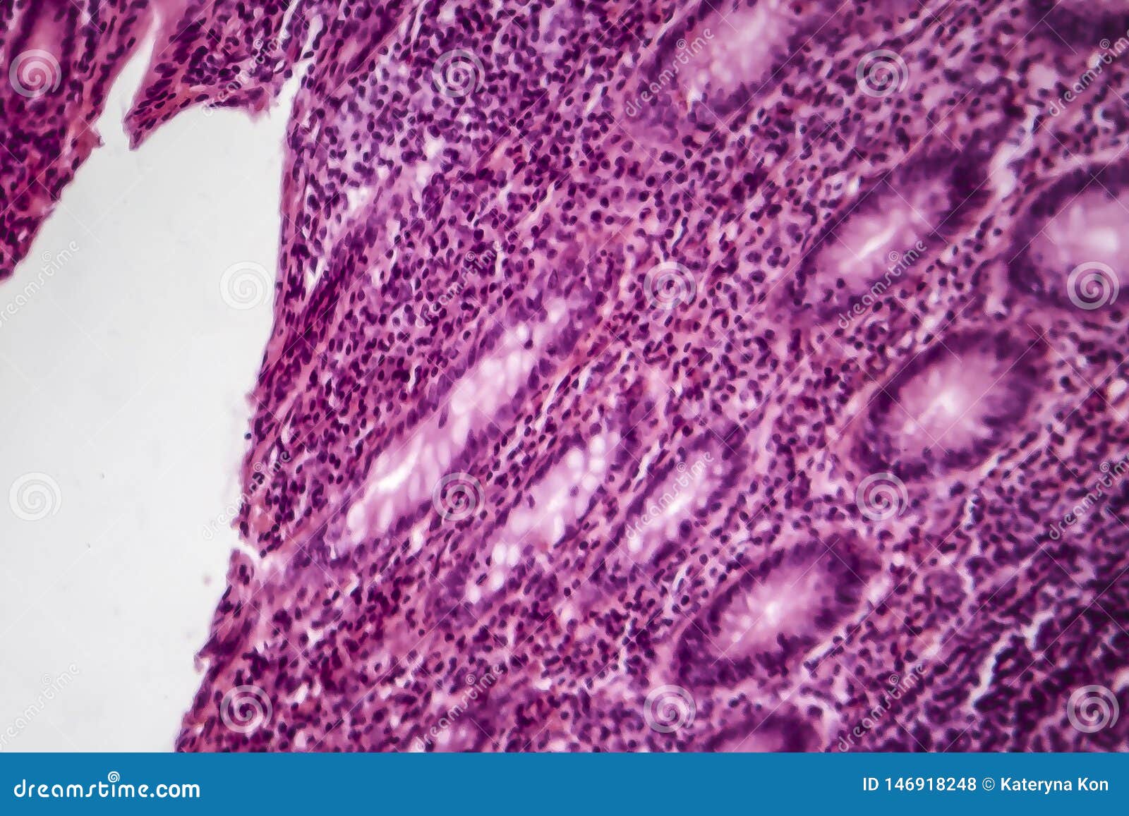 Acute Simple Appendicitis, Light Micrograph Royalty-Free Stock ...