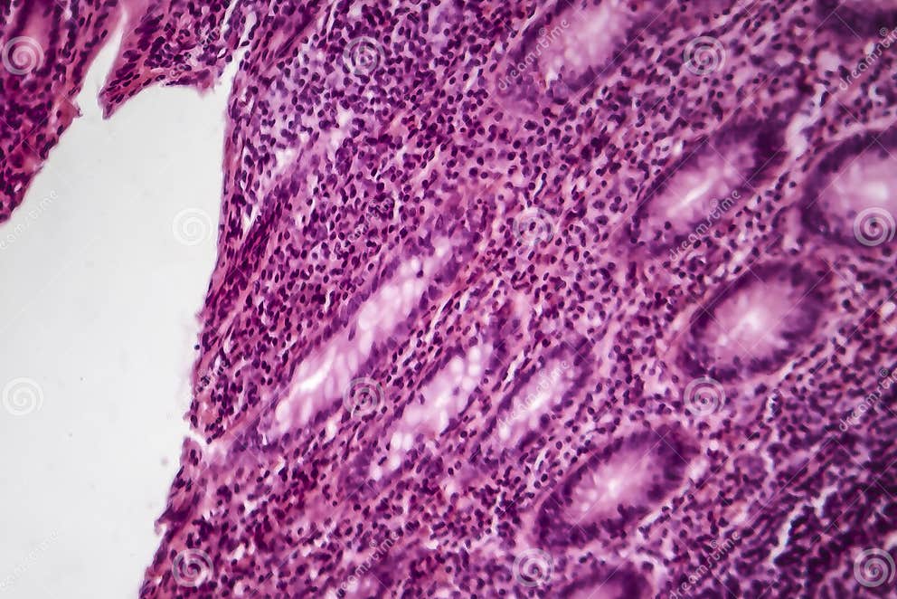 Acute Simple Appendicitis, Light Micrograph Stock Illustration ...