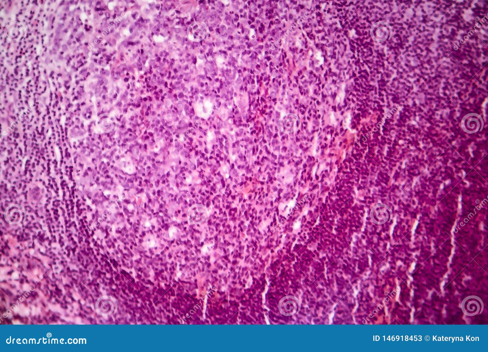 Acute Simple Appendicitis, Light Micrograph Stock Illustration ...